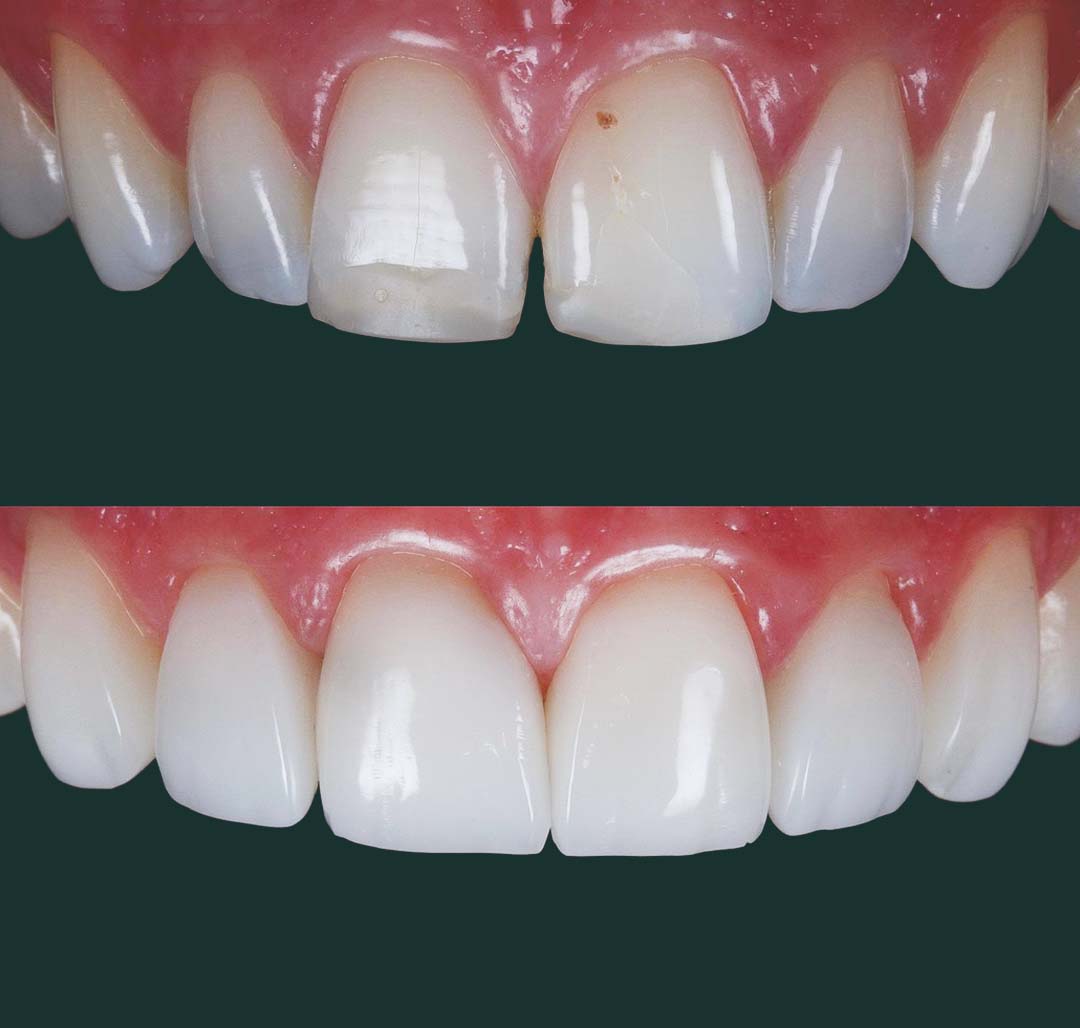 Composite Bonding Edgware | Tooth Bonding Mill Hill | Stanmore
